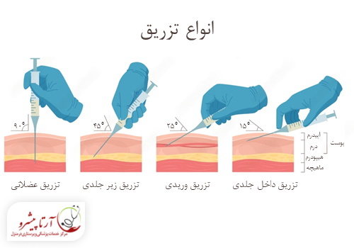 تزریق عضلانی چیست؟ آموزش روش، کاربردها و نکات ایمنی - مقاله آرتا پیشرو